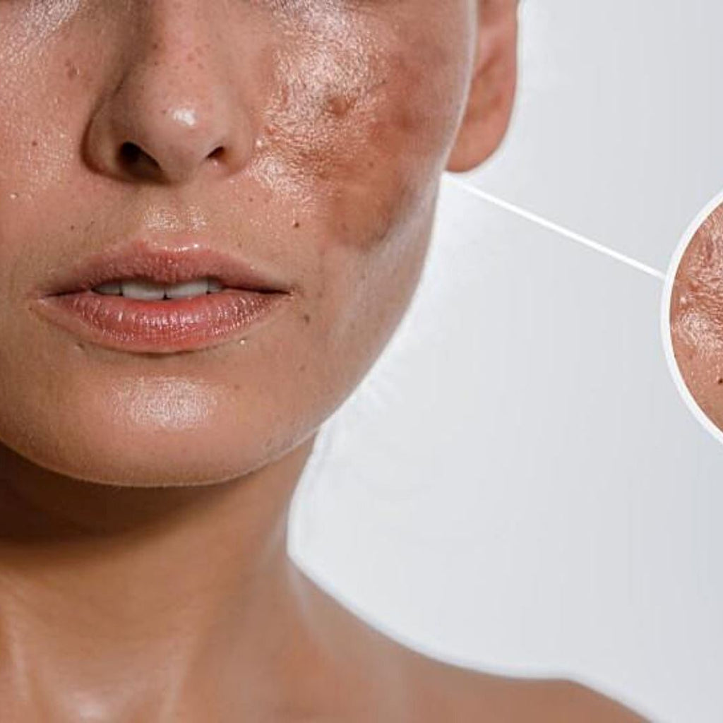 Hyperpigmentation 101: Types, Treatments, and Causes | Exclusive Beauty – Exclusive Beauty Club