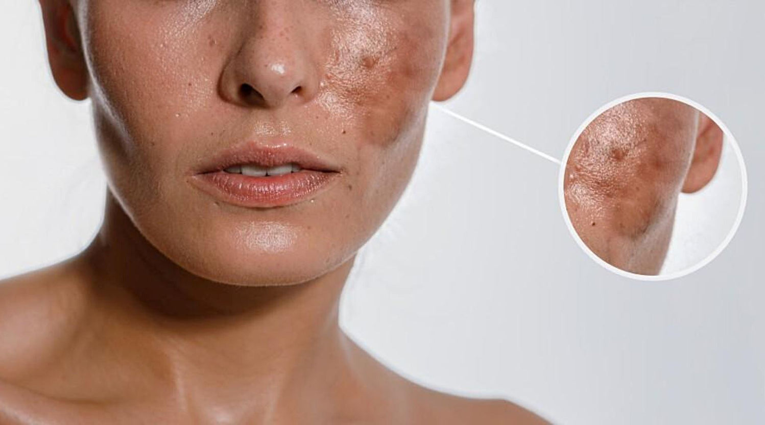 Hyperpigmentation 101: Types, Treatments, and Causes | Exclusive Beauty ...